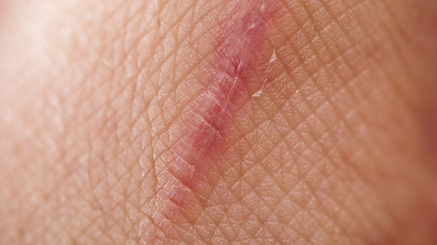 Wound Healing and Scars | Health Choices First