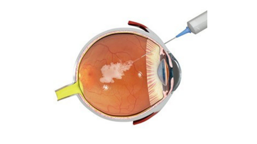 Advancements in the treatment of Geographic Atrophy | Health Choices First